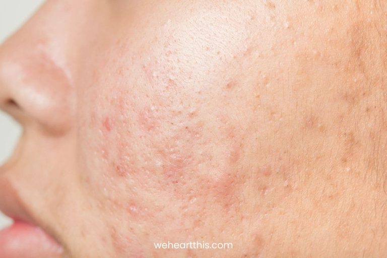 Fungal Acne Vs Closed Comedones: Are They Different?