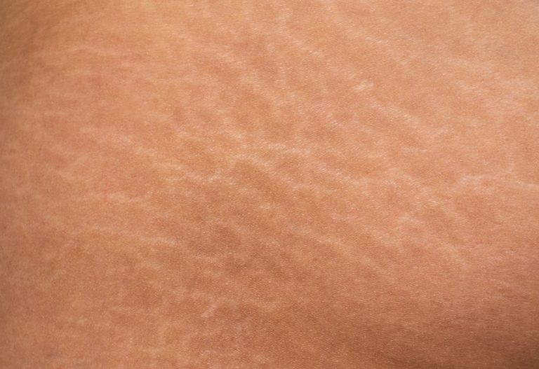 Microneedling For Stretch Marks Benefits Risks And More